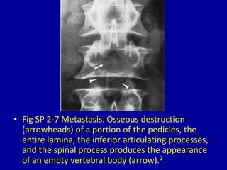 2 lytic lesion of a vertebral body or | PPTX