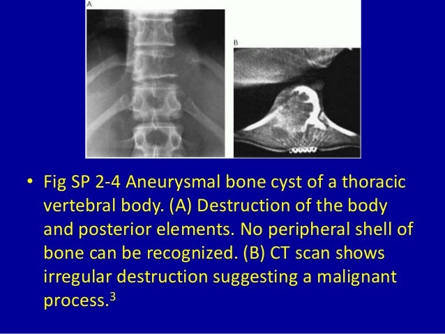 2 lytic lesion of a vertebral body or