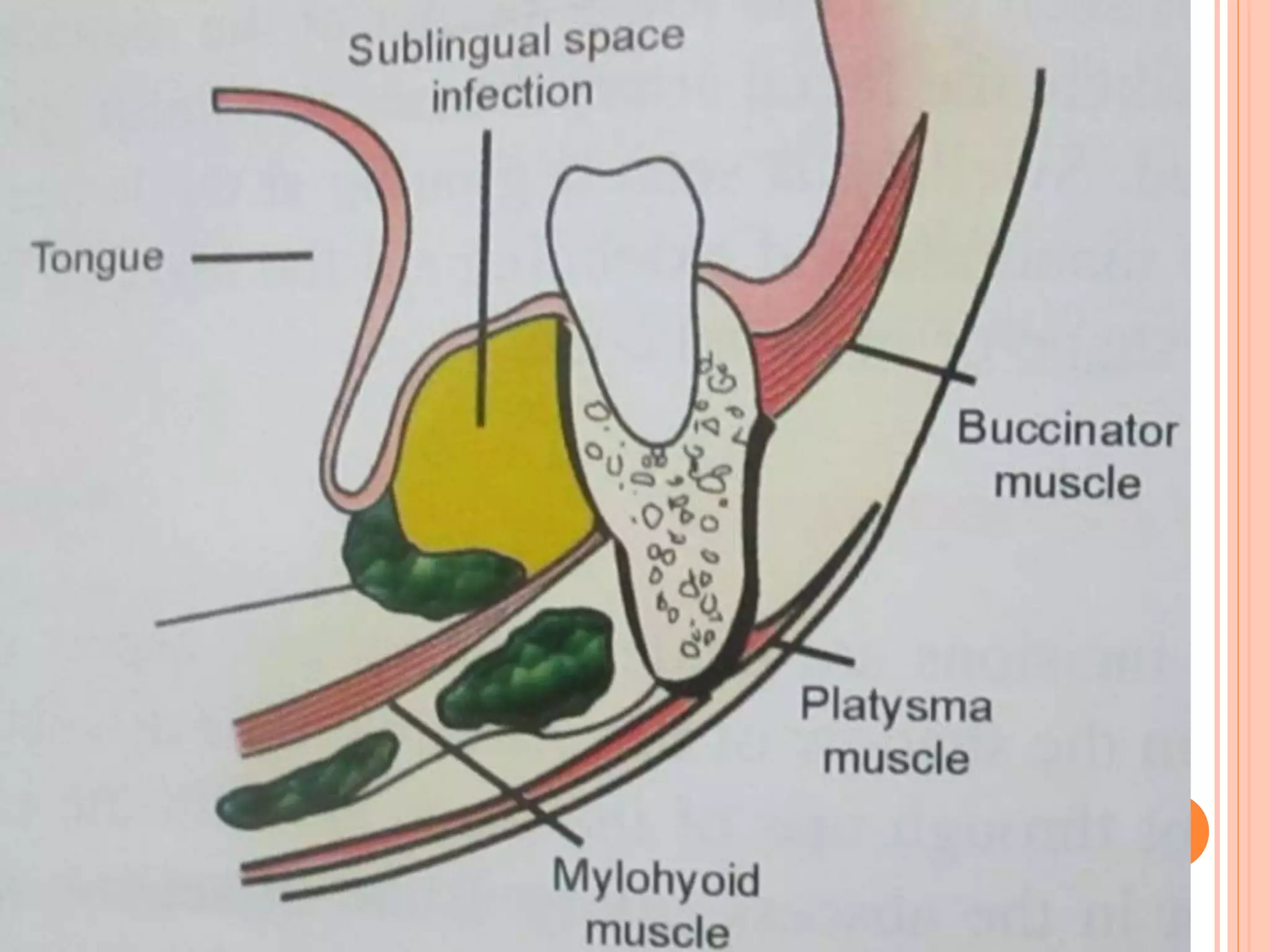 2 mandibular_spaceinfection-.pptx