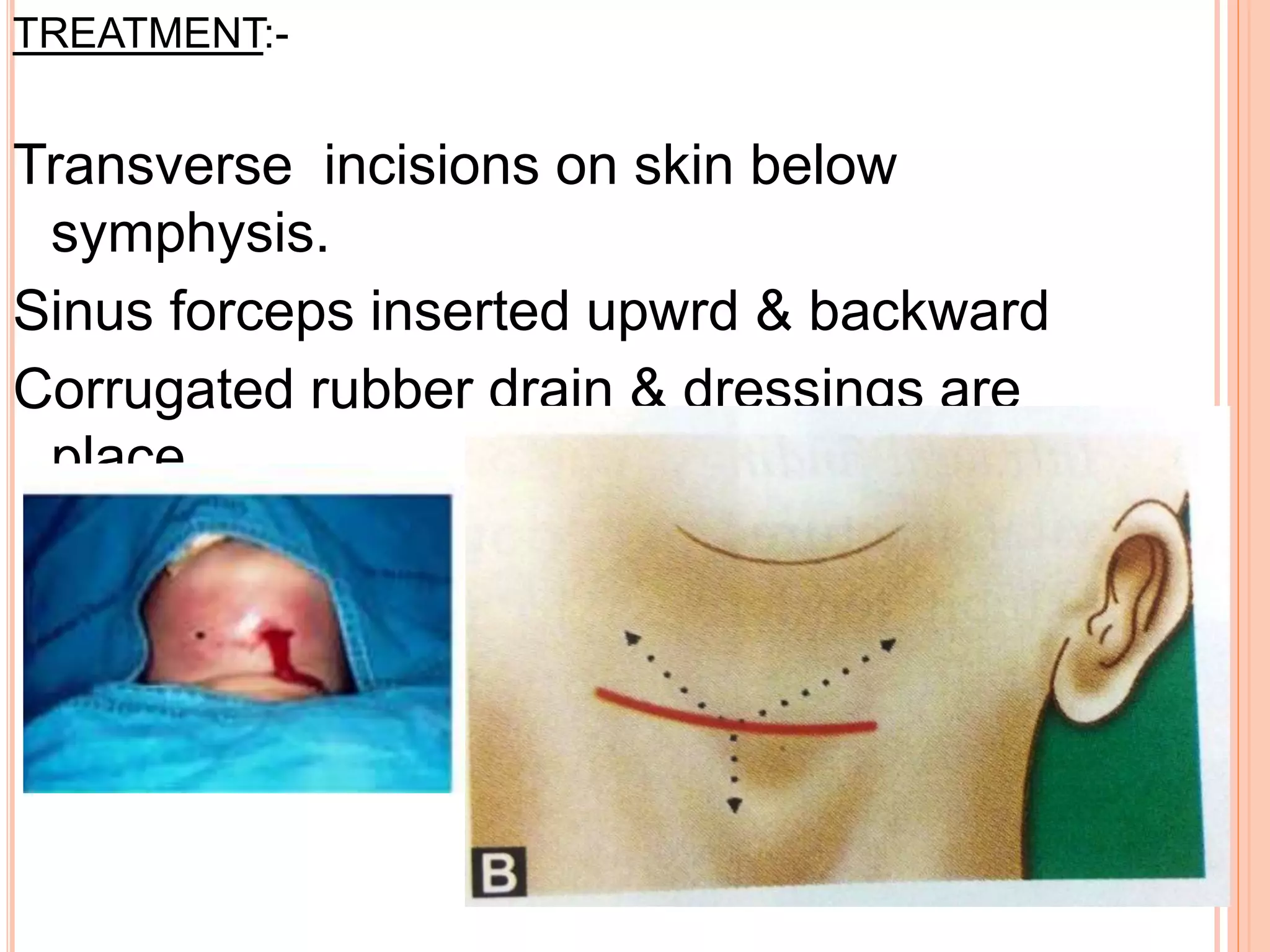 2 mandibular_spaceinfection-.pptx