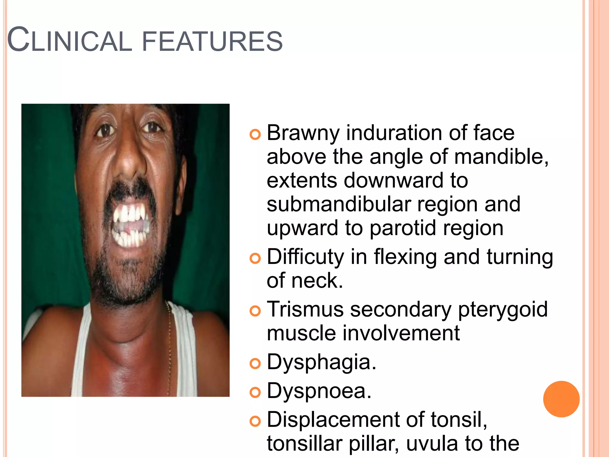 2 mandibular_spaceinfection-.pptx