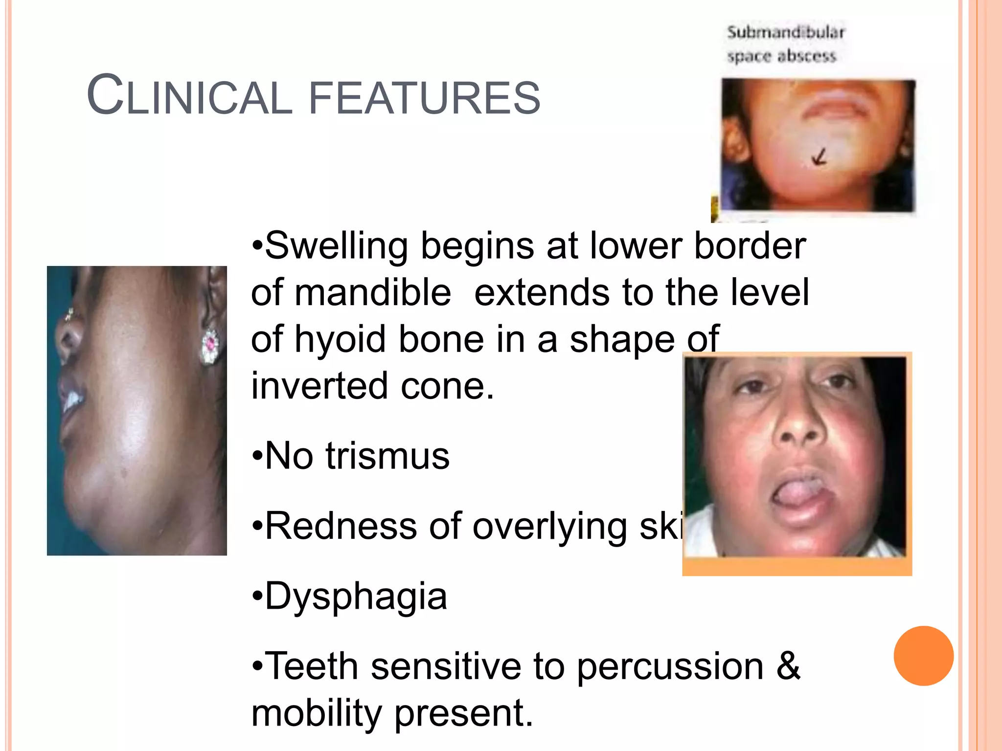 2 mandibular_spaceinfection-.pptx