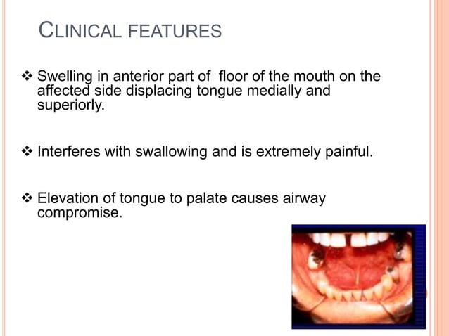 2 mandibular_spaceinfection-.pptx | Ear, Nose and Throat Conditions ...