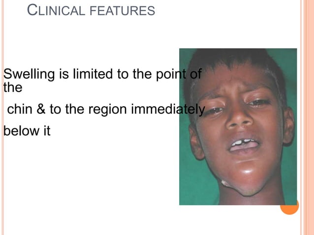 2 mandibular_spaceinfection-.pptx | Ear, Nose and Throat Conditions ...