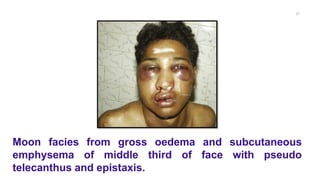 Lecture 2 maxillofacial trauma | PPTX