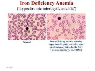 2 microcytic anemia i-iron deficiency.ppt