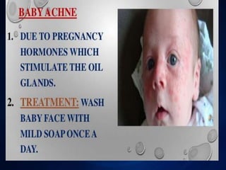 MIDWIFERY-MINOR DISORDERS OF NEWBORN BABY | PPT