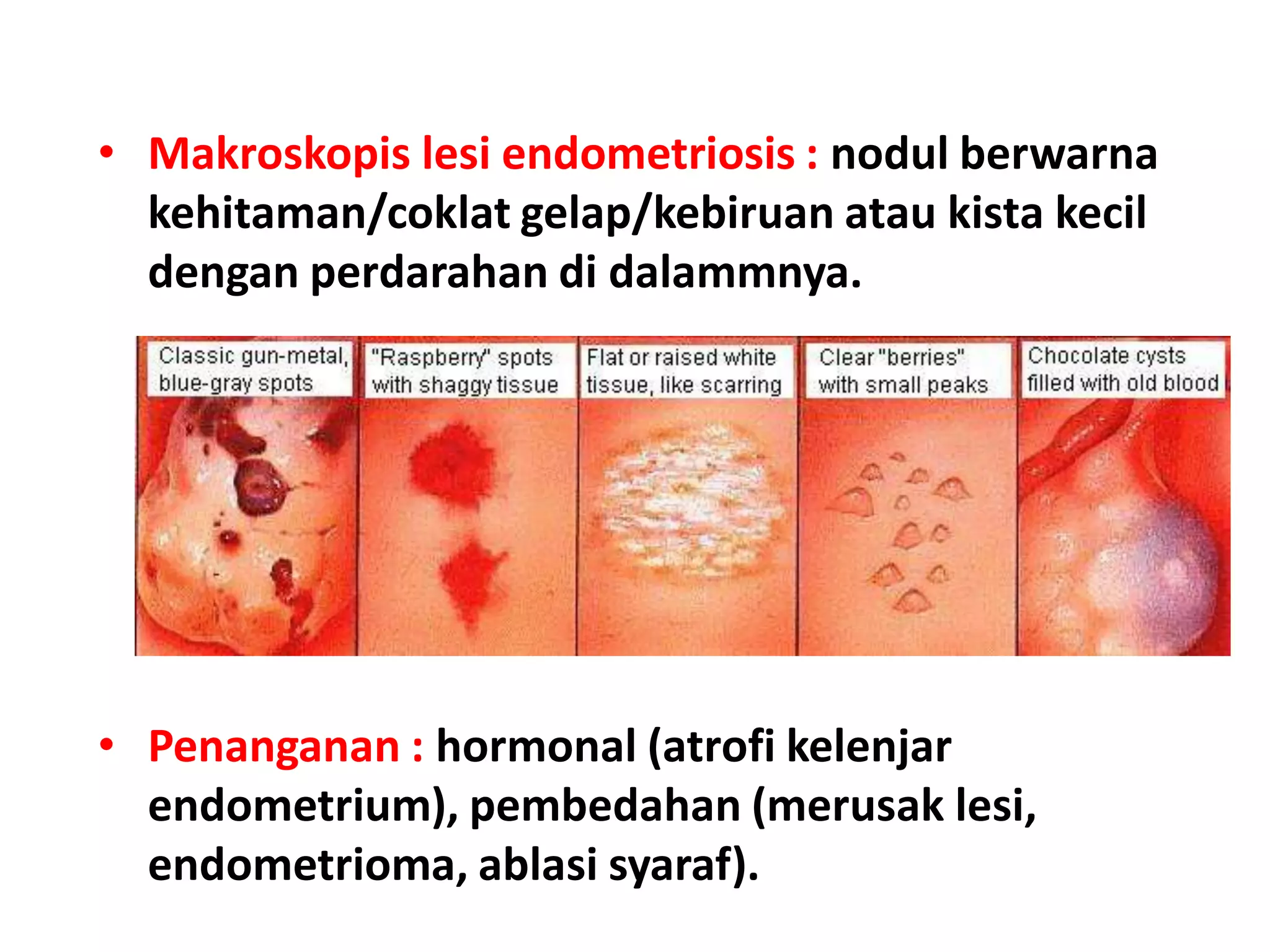 Mola hidatidosa dan Koriokarsinoma, endometriosis | PDF