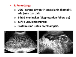 Mola hidatidosa dan Koriokarsinoma, endometriosis | PDF