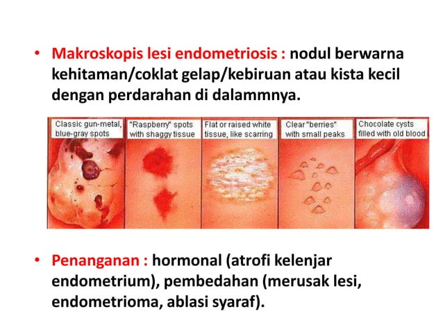 Mola hidatidosa dan Koriokarsinoma, endometriosis | PDF
