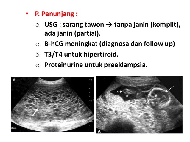 Mola hidatidosa dan Koriokarsinoma, endometriosis