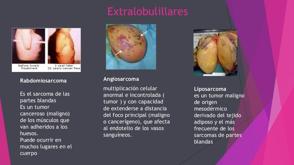 TUMORES BENIGNOS Y MALIGNOS DE MAMA