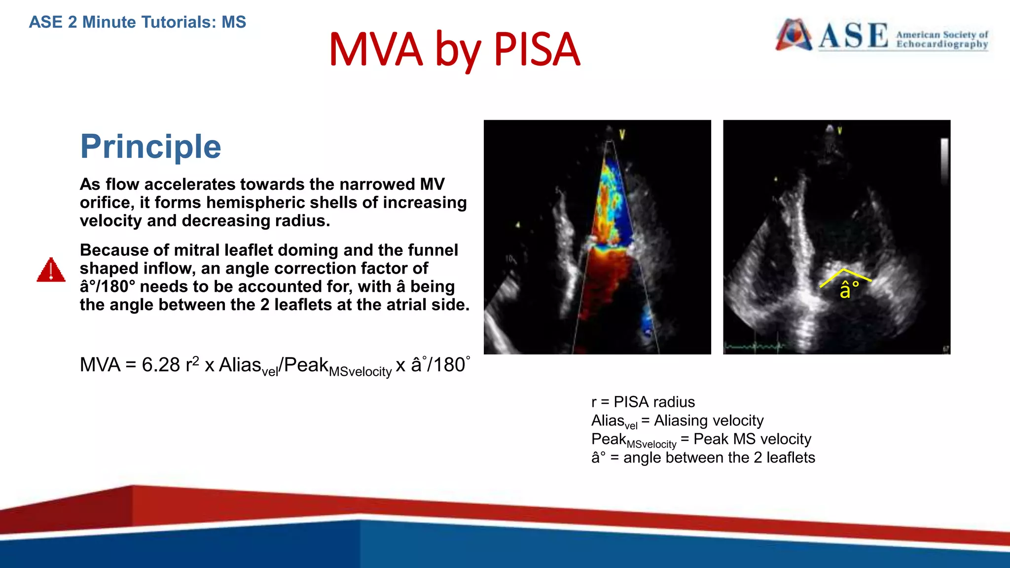 2MT-Mitral-Stenosis-SH-adjustedVR.pptx | Heart and Cardiovascular ...
