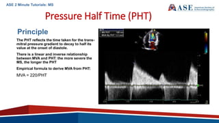 2MT-Mitral-Stenosis-SH-adjustedVR.pptx | Heart and Cardiovascular ...