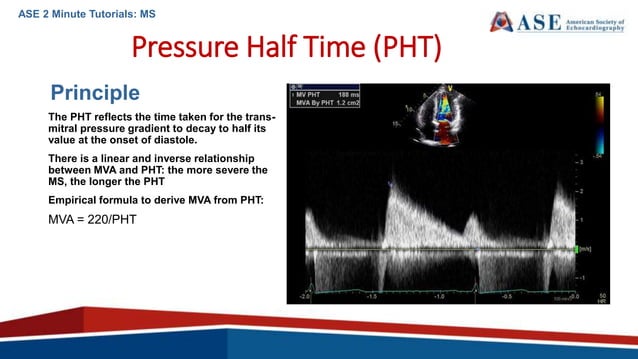 2MT-Mitral-Stenosis-SH-adjustedVR.pptx