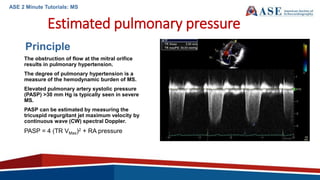 2MT-Mitral-Stenosis-SH-adjustedVR.pptx | Heart and Cardiovascular ...