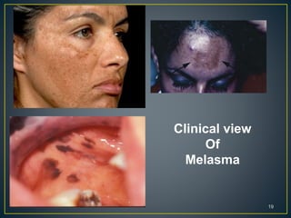 Multifocal diffuse pigmentation in oral medicine | PPT