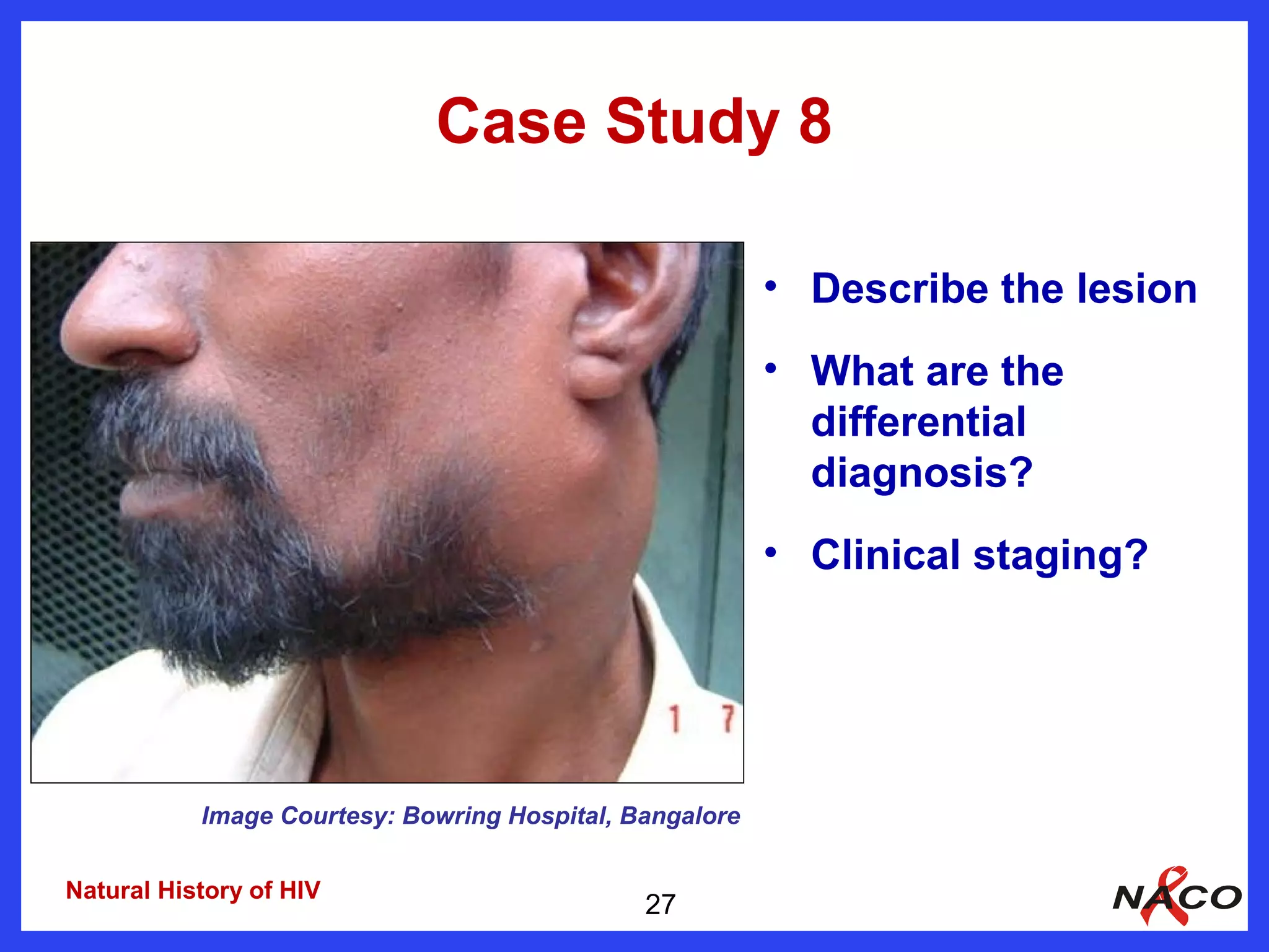 2 natural history of hiv and who clinical staging naco lac m | PPT