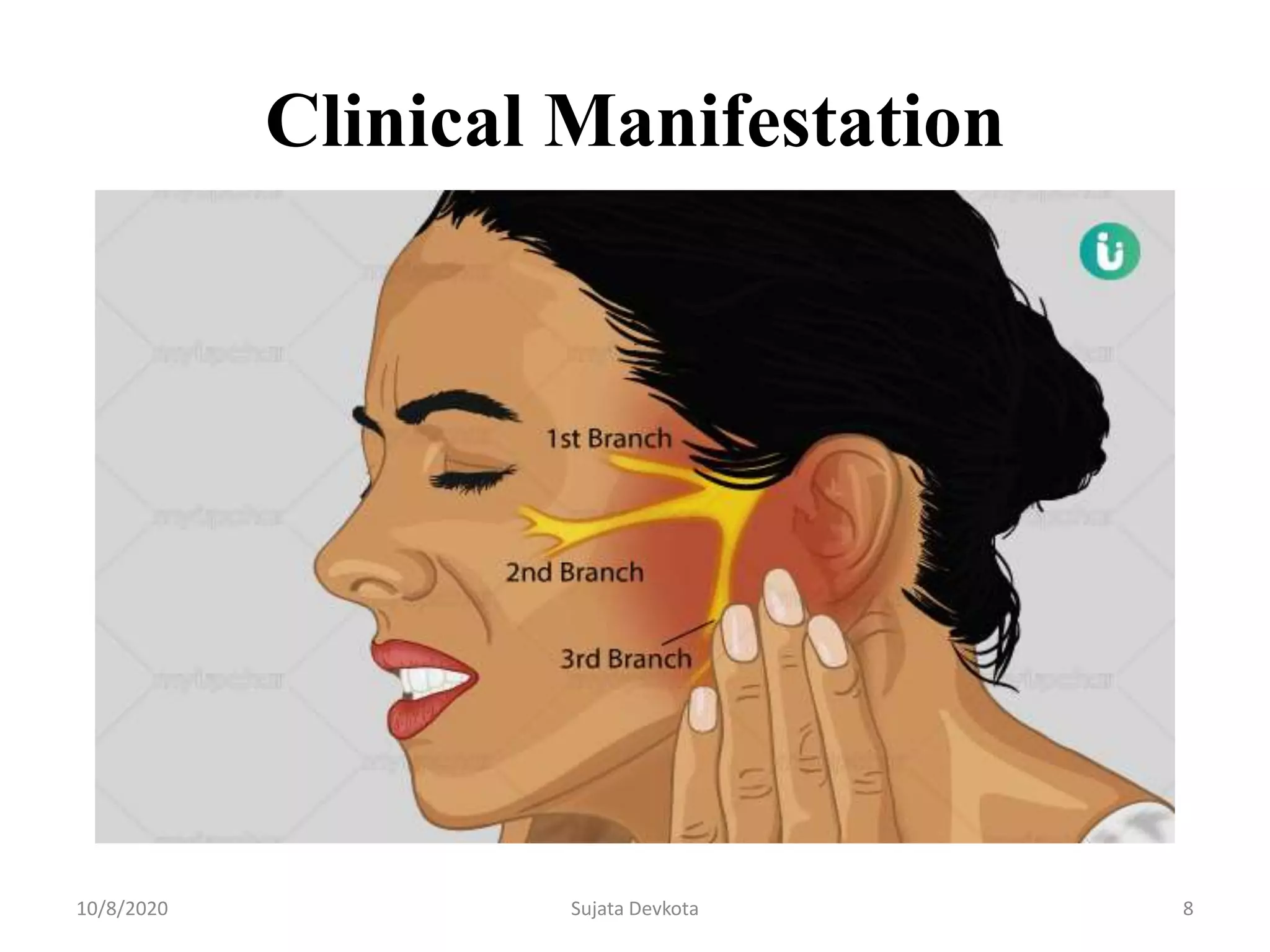 Trigeminal Neuralgia and bell's palsy | PPTX