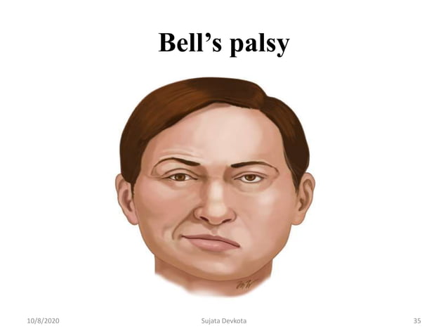 Trigeminal Neuralgia and bell's palsy | PPTX