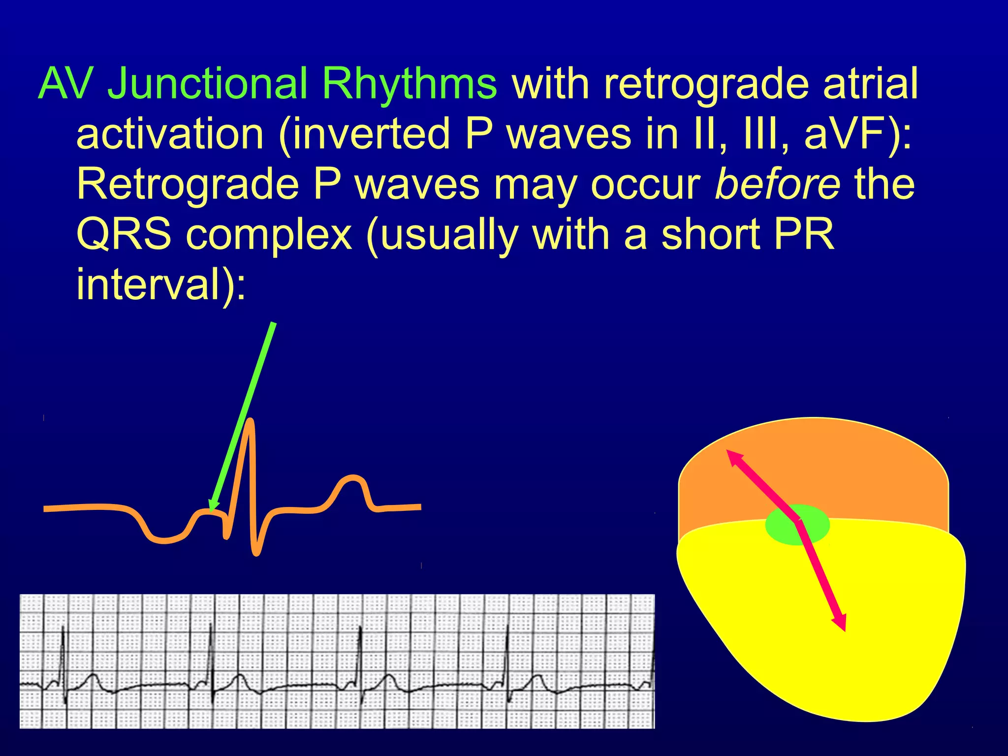 2nd part ECG basics PR interval and heart block | PPT