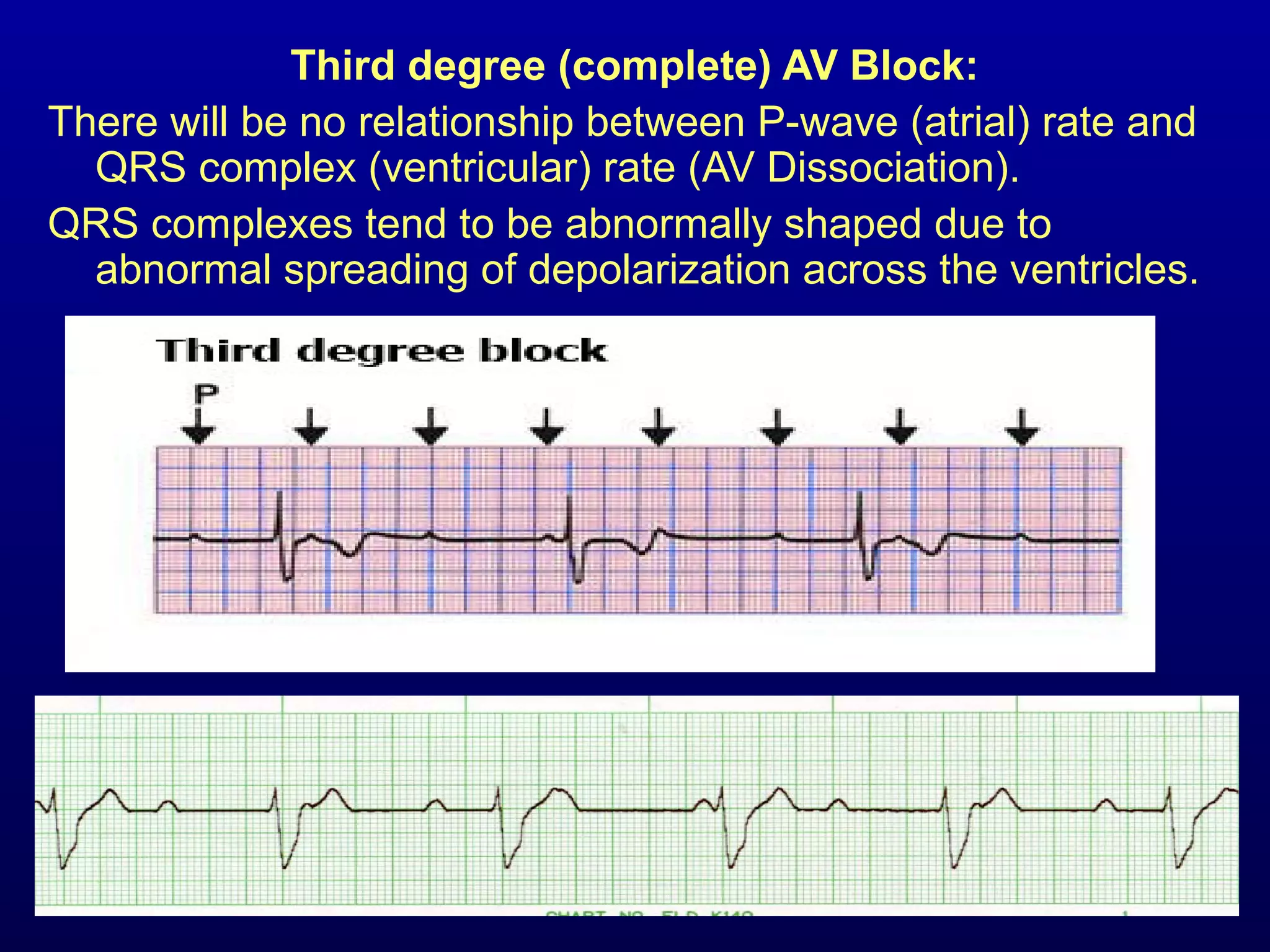 2nd part ECG basics PR interval and heart block | PPT