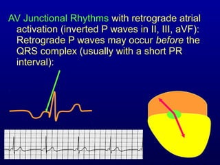 2nd part ECG basics PR interval and heart block | PPT