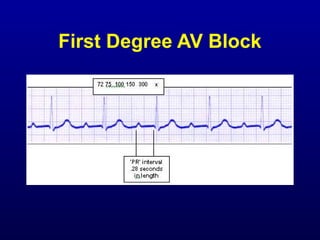 2nd part ECG basics PR interval and heart block | PPT