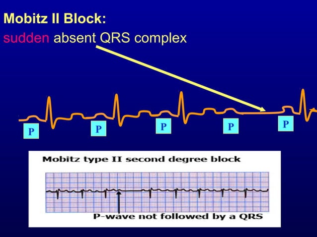 2nd part ECG basics PR interval and heart block | PPT | Heart and ...