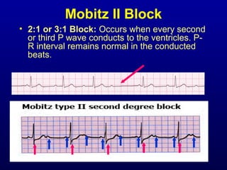 2nd part ECG basics PR interval and heart block | PPT