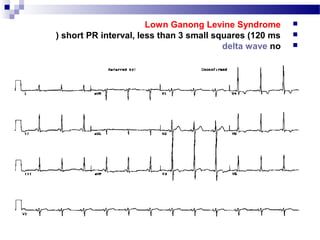 2nd part ECG basics PR interval and heart block | PPT