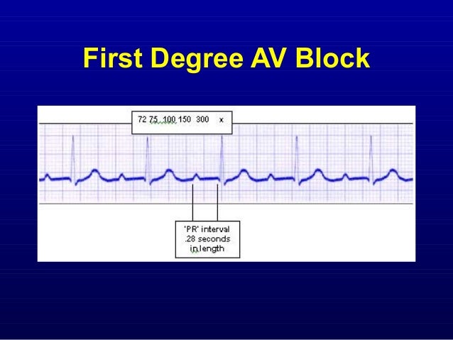 2nd part ECG basics PR interval and heart block