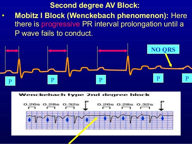 2nd part ECG basics PR interval and heart block