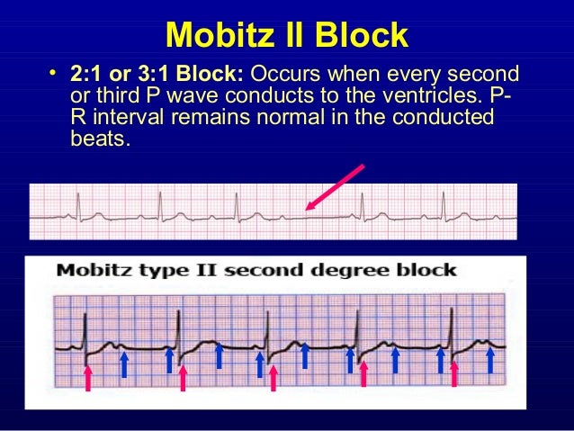 2nd part ECG basics PR interval and heart block