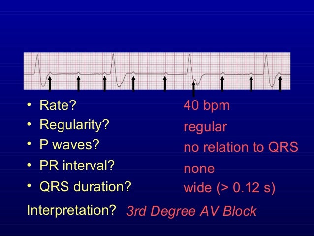 2nd part ECG basics PR interval and heart block
