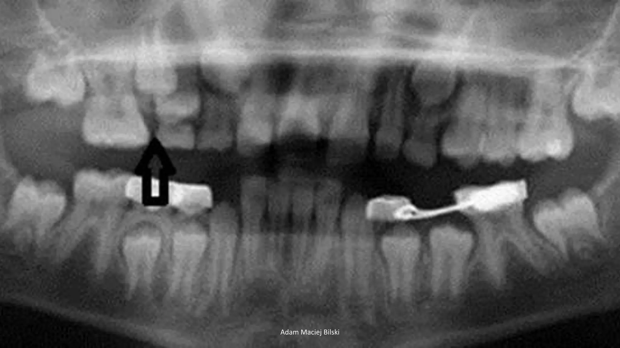 2nd Upper Premolar Anatomy | PPTX