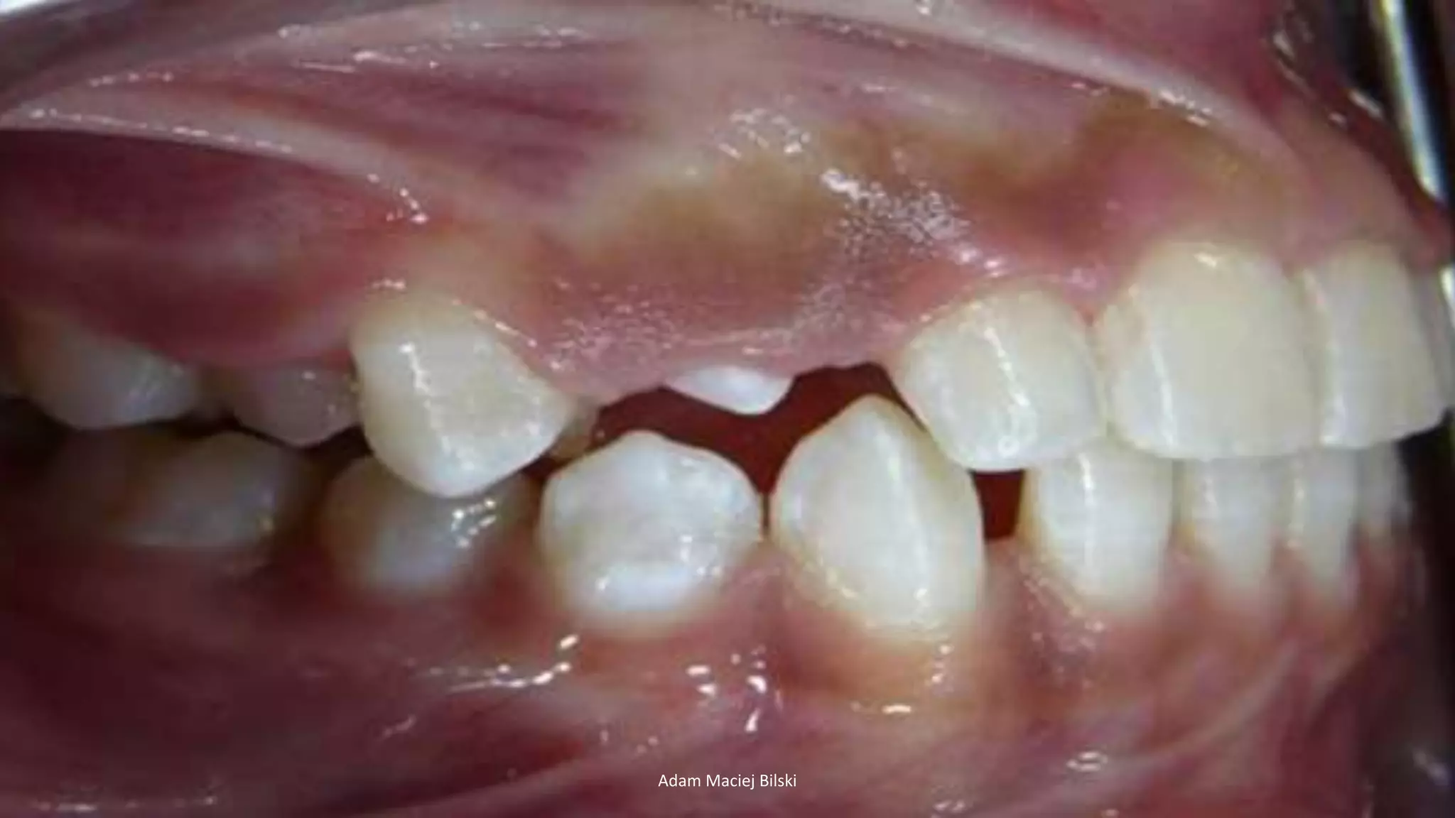 2nd Upper Premolar Anatomy | PPTX