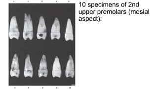 2nd Upper Premolar Anatomy | PPTX