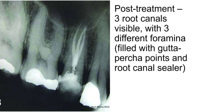 2nd Upper Premolar Anatomy | PPTX
