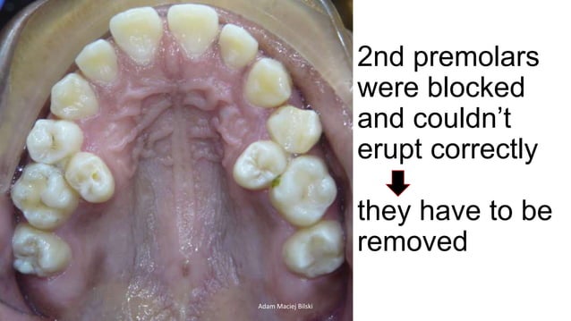 2nd Upper Premolar Anatomy | PPTX