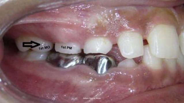 2nd Upper Premolar Anatomy | PPTX