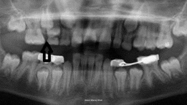 2nd Upper Premolar Anatomy | PPTX