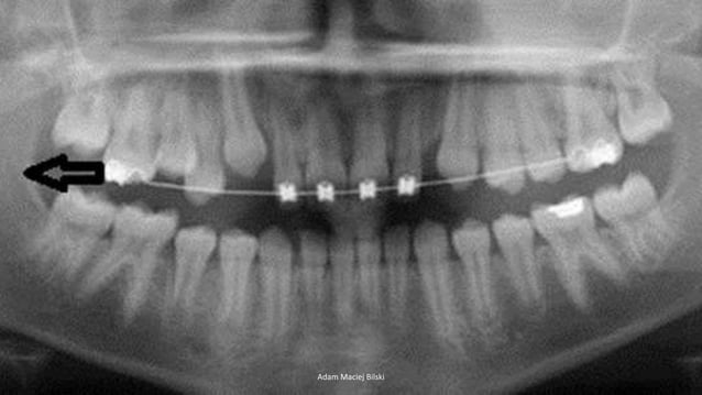 2nd Upper Premolar Anatomy | PPTX