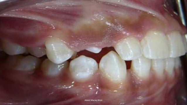 2nd Upper Premolar Anatomy | PPTX