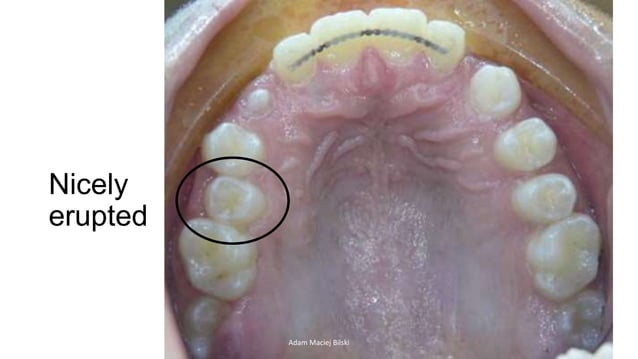 2nd Upper Premolar Anatomy | PPTX