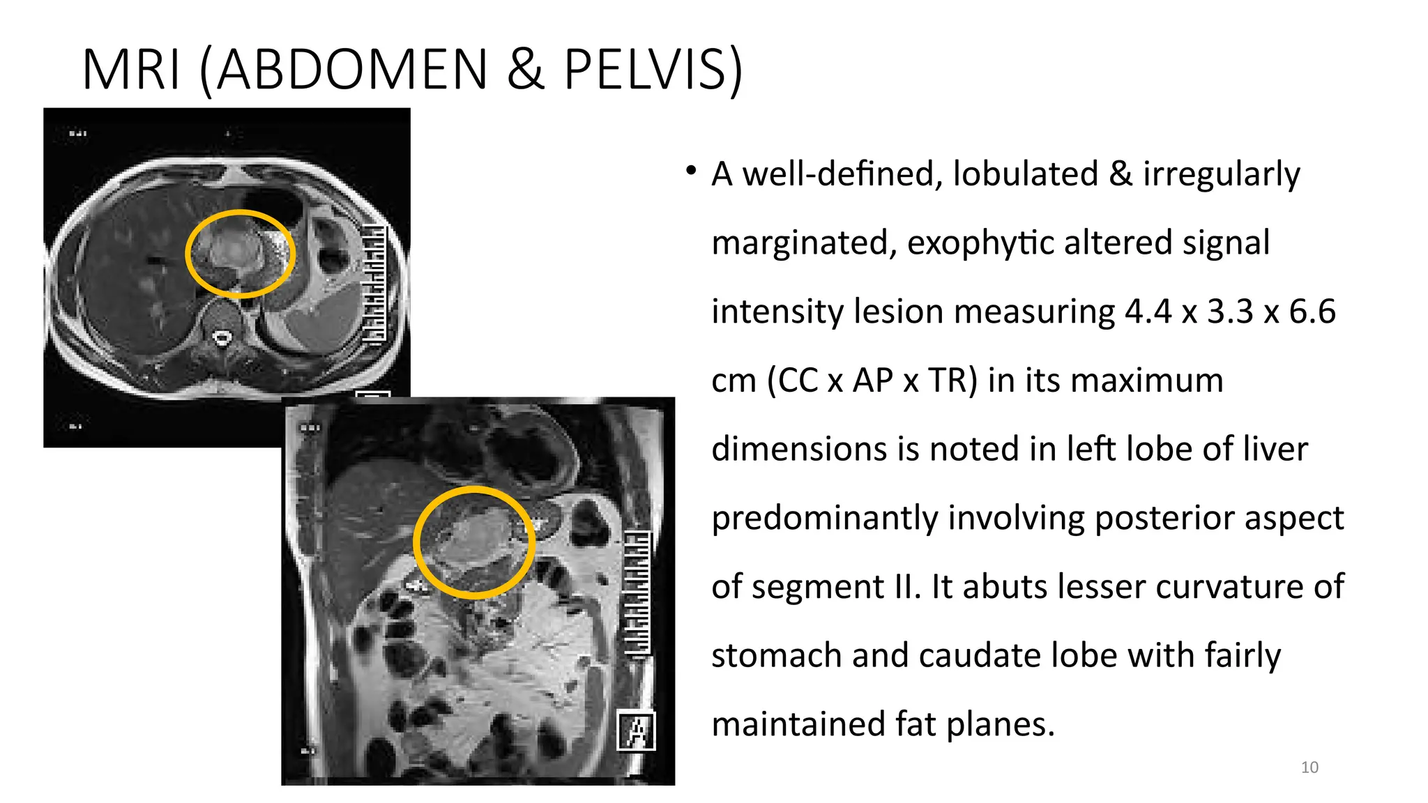 Liver Resection in a Case of Cavernous Hemangioma | PPTX