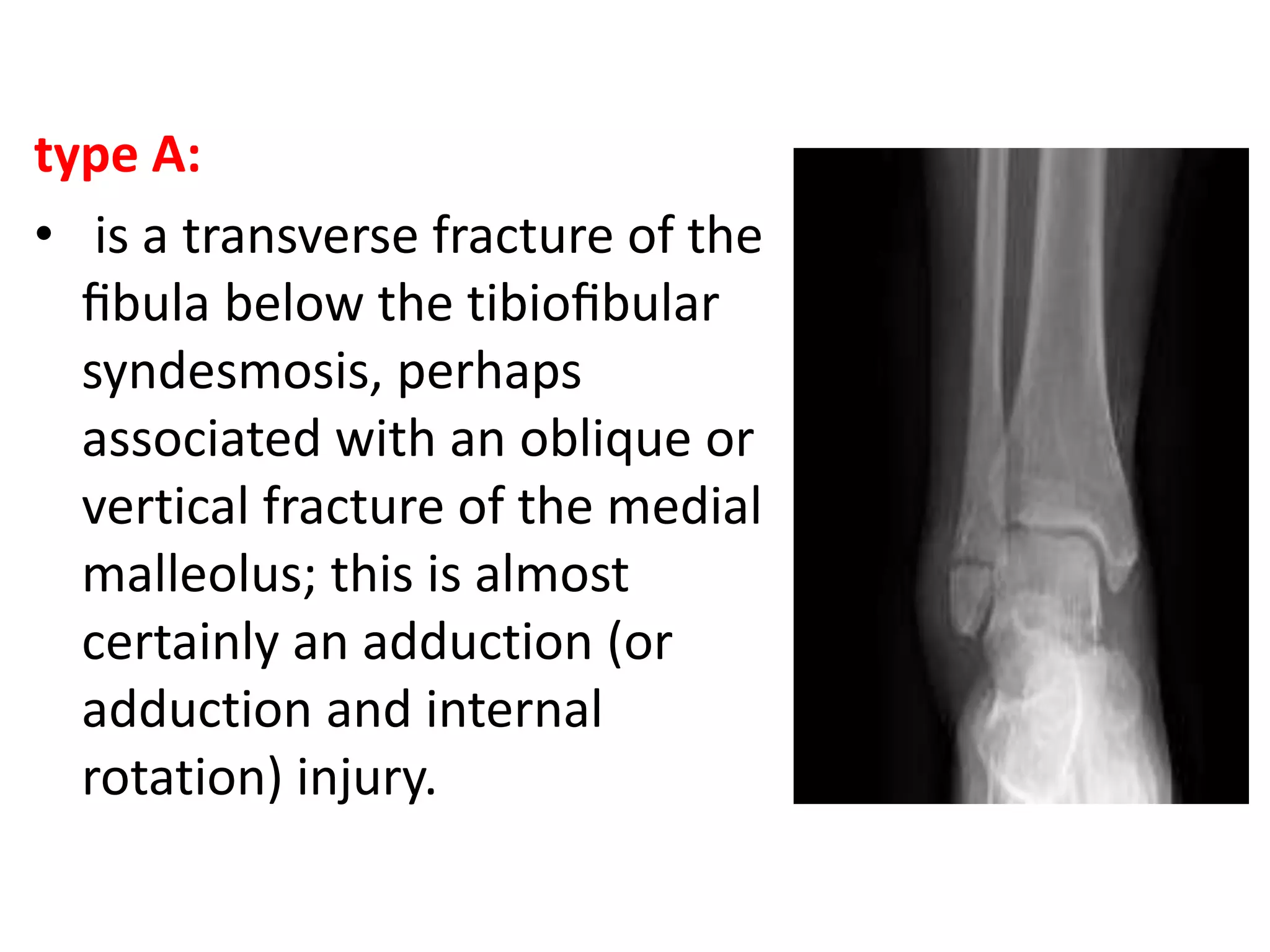 Malleolar fracture | PPTX
