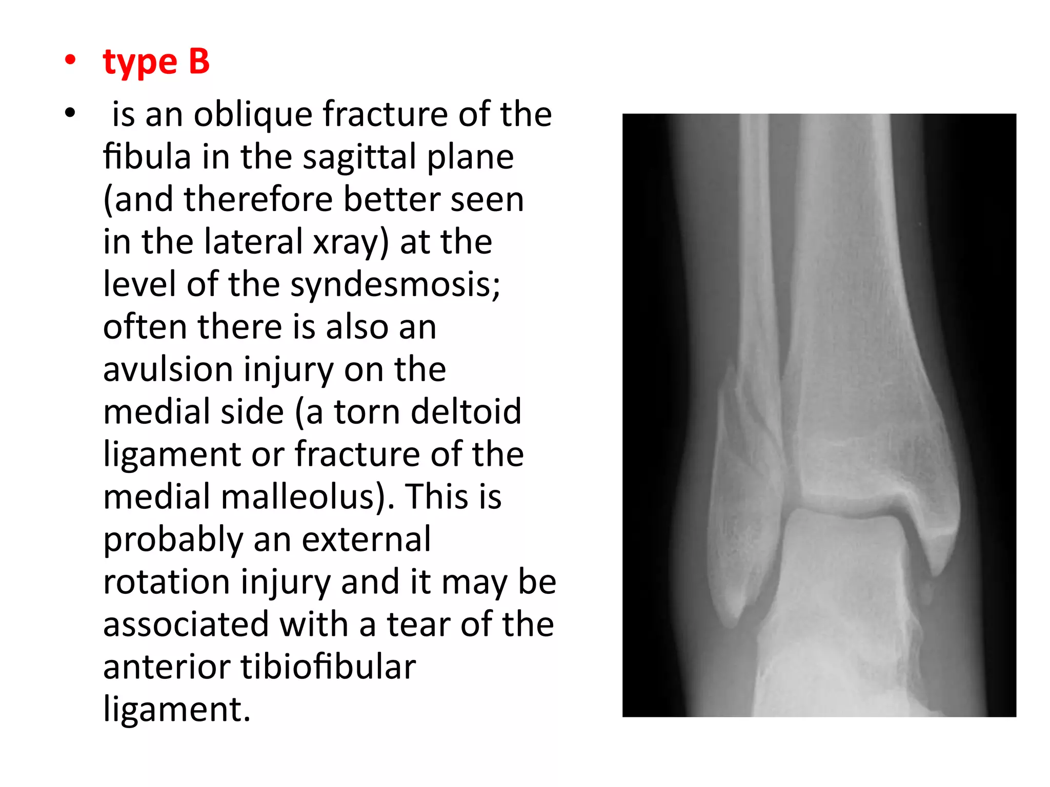Malleolar fracture | PPTX | Death, Injury, or Military Conflict ...