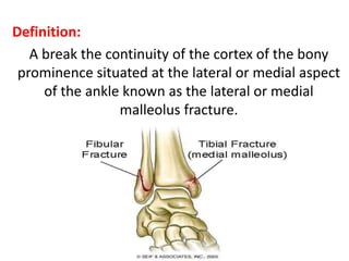 Malleolar fracture | PPTX