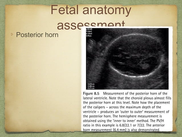 2nd trimester scan | PPT